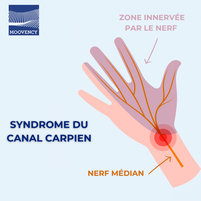 Zoom sur un TMS : Le syndrome du canal carpien - Moovency