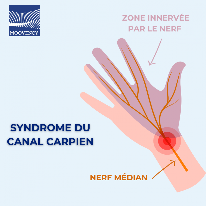 Zoom sur un TMS : Le syndrome du canal carpien - Moovency