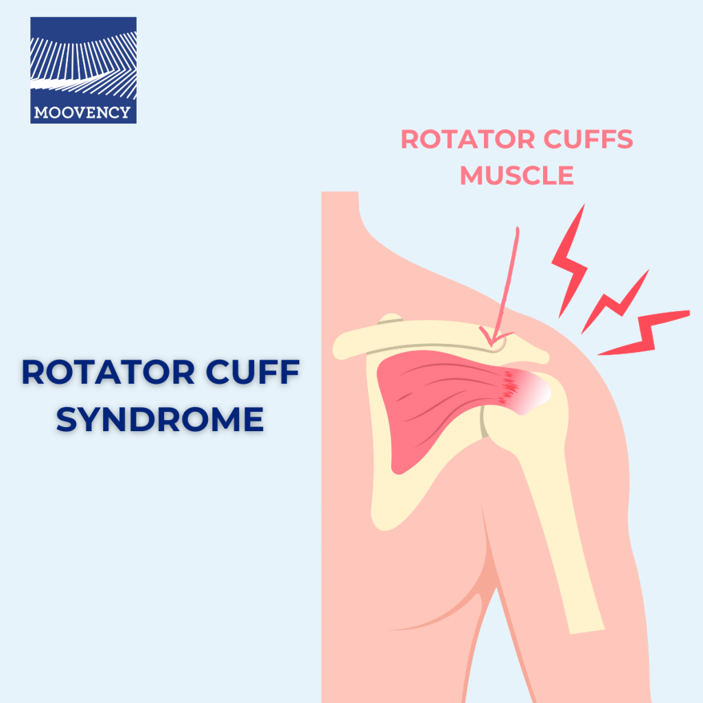 Focus on MSD #2: Rotator cuff syndrome - Moovency