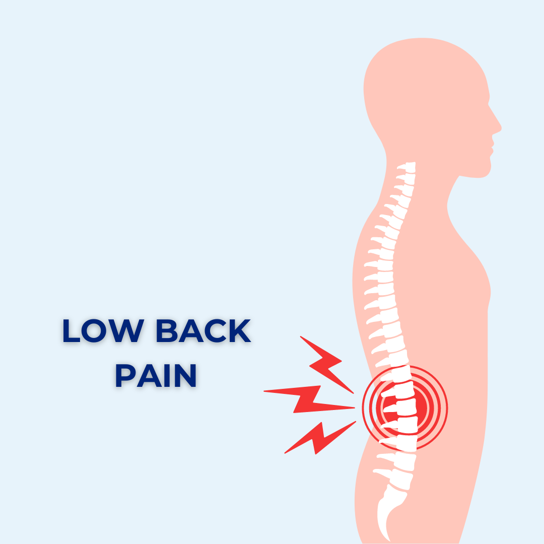 Focus on a MSD #3: Low back pain - Moovency